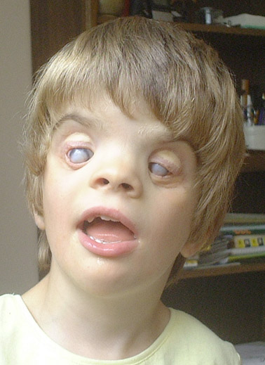 Informations sur le Syndrome de Robinow – Rubrique à brac du XXIe siècle